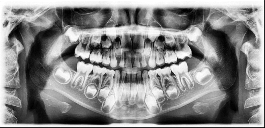 Dental Radiographs (X-Rays) - Richmond Dentistry for Children